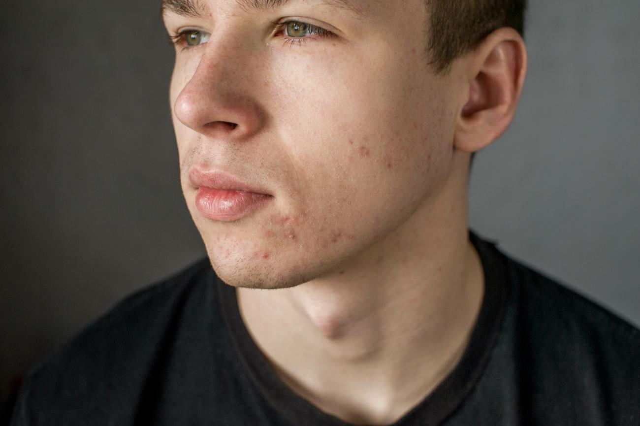 5 Acne Myths You May Still Believe | Patrick Hatfield MD Dermatology ...
